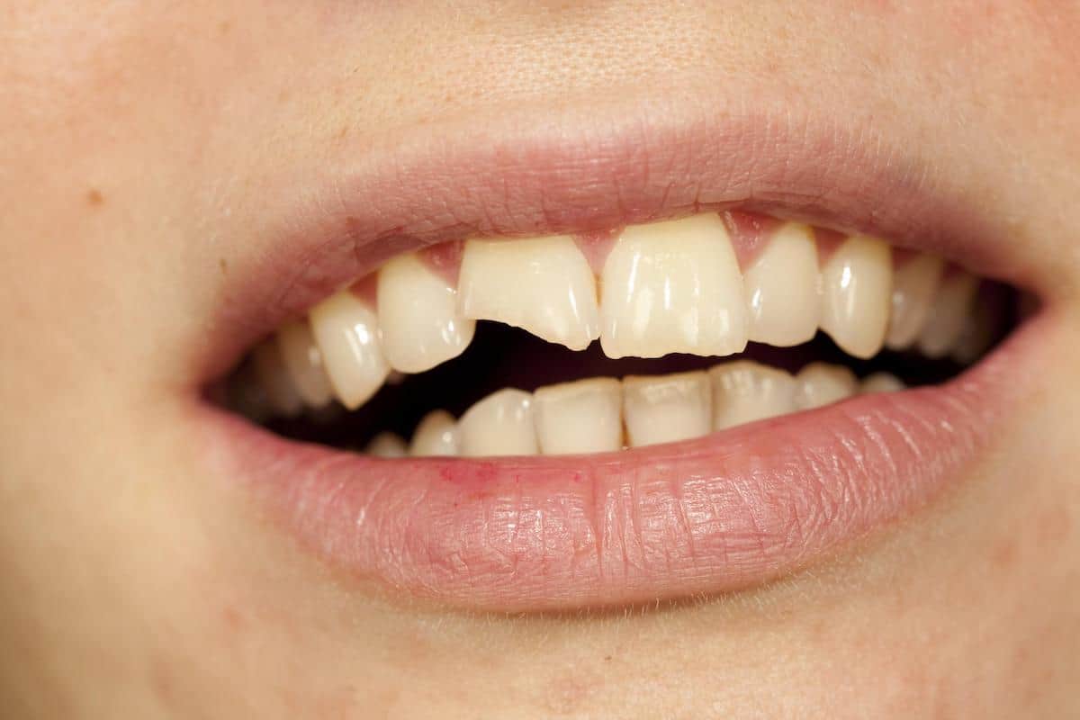 I Chipped My Dental Implant Is It Serious What Can I Do 
